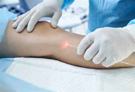 Endovenous Ablation Vein Care Northwell Health