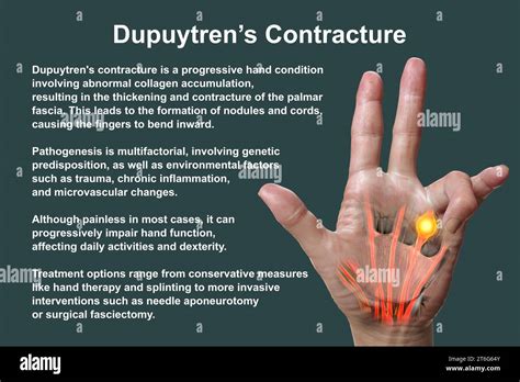 A 3d Medical Illustration Displaying A Patients Hand With Dupuytrens