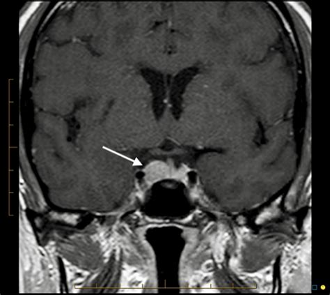 Five Years Postoperative Pituitary Mri Showing A 10 Mm Tumor On The