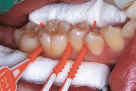 Gv Black S Classification Of Dental Caries Explained From Basics