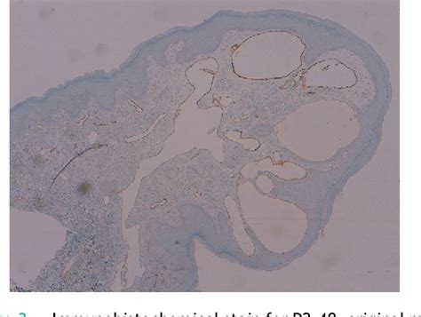 Figure 3 From Pseudoverrucous Lesions Of Recent Appearance On The Vulva
