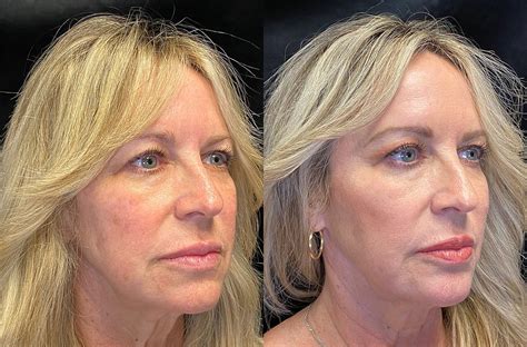Patient 148255699 Dermal Fillers Before And After Photos Modern Women