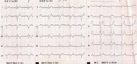 Ecg Of The Patient Reported Here Showing A Type 2 Pattern Brugada