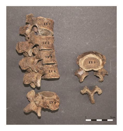 Spondylolysis Of L5 With Six Lumbar Vertebrae In A Specimen Of Unknown