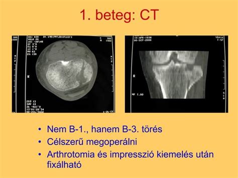 Role Of Ct In The Diagnostics Of Proximal Intraarticular Tibia Fractures Power Point Ppt