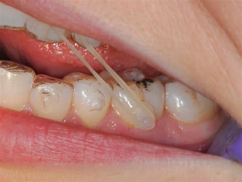 Ceramic Button Dental And Orthodontic Supplies Uae Heather And White