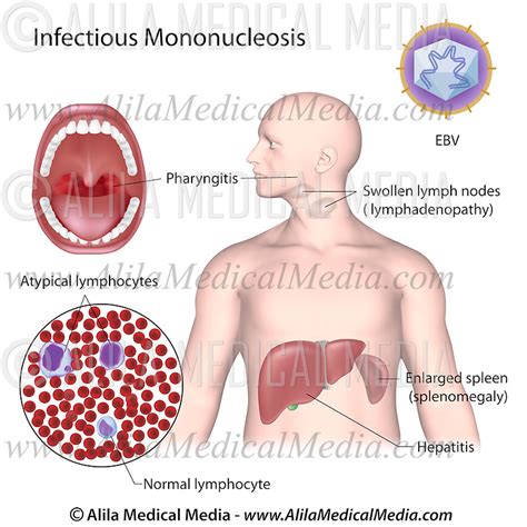 What Are The Warning Signs Of Mononucleosis At Dolores Robertson Blog