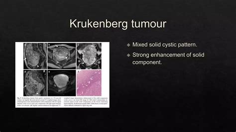 Ovarian Cancer Ppt Vppptx