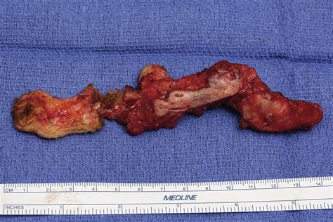 Heterotopic Ossification Of The Xiphoid After Chest Compressions The Annals Of Thoracic Surgery