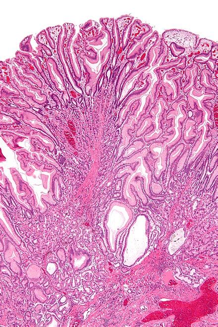 Quiz Gastrointestinal Polyps Libre Pathology