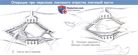 Техника операции при переломе локтевого отростка локтевой кости