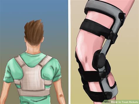 How To Treat Rickets 14 Steps With Pictures Wikihow