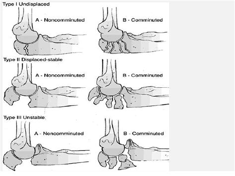 Olecranon Fracture Classification Olecranon Fracture Classification