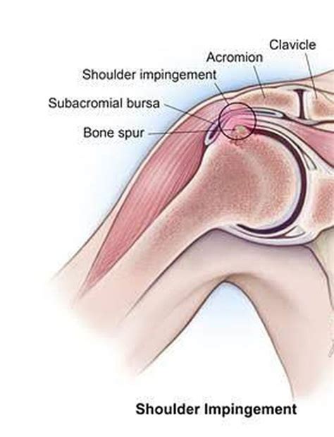 Shoulder Impingement Syndrome Medizzy