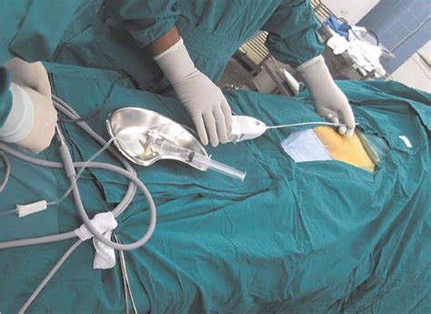Spinal Epiduroscopic Laser Therapy Neupsy Key