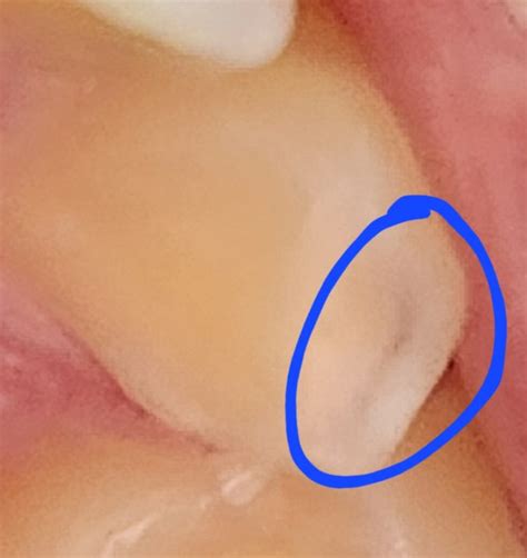 충치 인가요 지식in