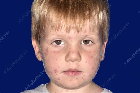 Chickenpox Stock Image C047 5977 Science Photo Library