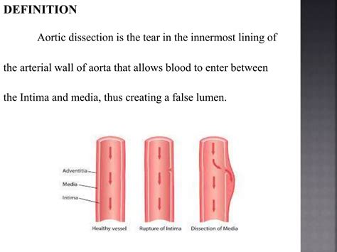 Aortic Dissection Pptx