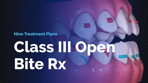 [premium] Nine Treatment Plans Class Iii Open Bite Rx Nine Treatment Plans