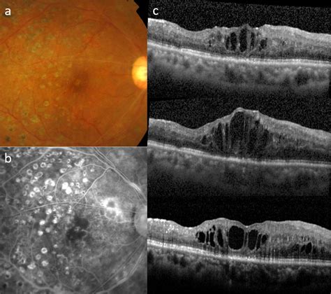 Example Images From A 62 Year Old Man With Dme Treated By Srt Who Had