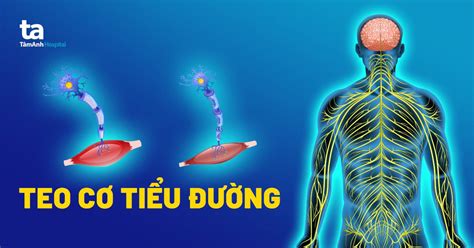 Bệnh Teo Cơ Do đái Tháo đường Nguyên Nhân Và Triệu Chứng