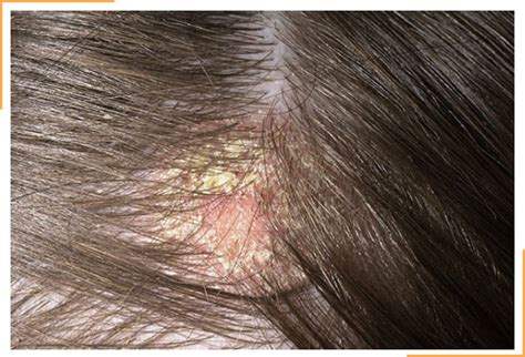 Scalp Psoriasis Natural Psoriasis TreatmentNatural Psoriasis Treatment