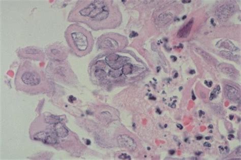 Pathology Of The Upper GI Tract Flashcards Quizlet