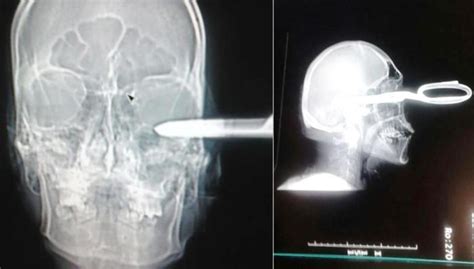 These Insane X Rays Will Make You Wonder How That Got There 37 Pics