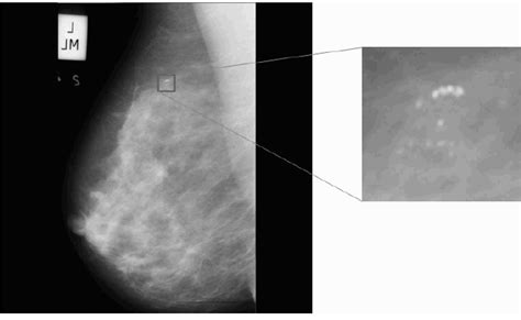An Example Of Micro Calcification In Mammogram Image Download