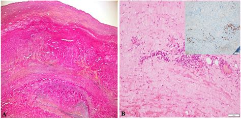 A Thickened Arterial Wall With Intimal And Adventitial Thickening And Download Scientific