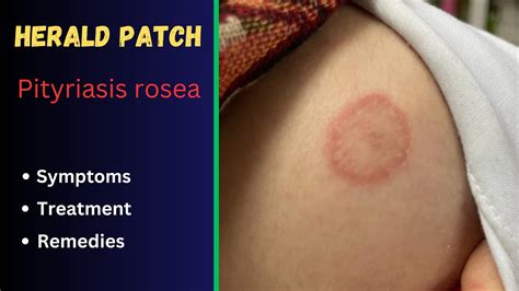 Pityriasis Rosea Herald Patch