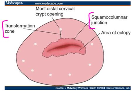 Cervix Disorders High Yield Flashcards Quizlet