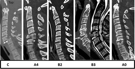 Extent Of Spinal Cord Decompression In Motor Complete American Spinal