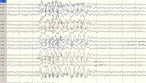 Interictal Epileptiform Discharges Before And After A Generalized Tonic