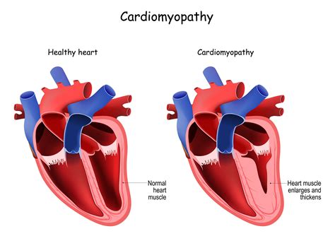2 Hypertrophic Obstructive Cardiomyopathy Recent Medical News