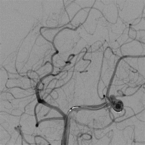 The Insertion Of Coils Into The Aneurysm The Tip Of The Microcatheter