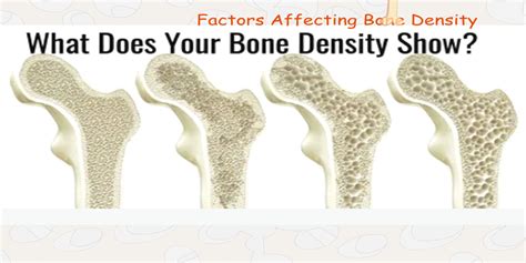 Bone Density And Its Importance Dr Ramprasad Dharangutti
