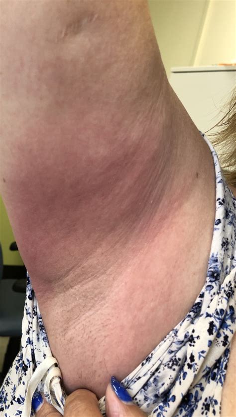 Zoledronic Acid Induced Symmetrical Drug Related Intertriginous And Flexural Exanthema Sdrife