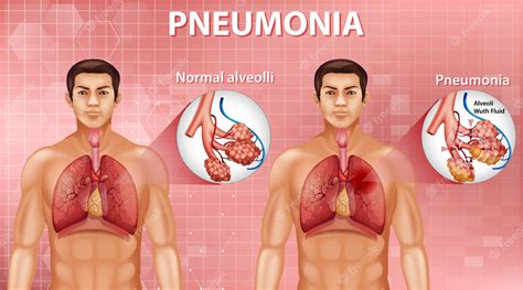 Premium Vector Comparison Of Healthy Alveoli And Pneumonia