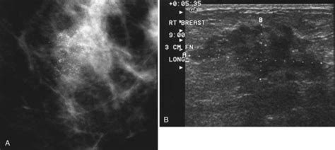Mammogram Interpretation Radiology Key