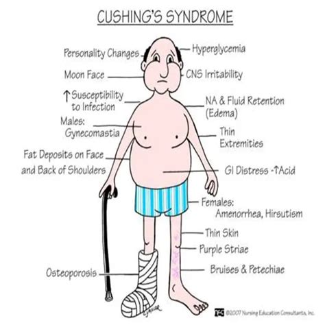 What Is Cushing Syndrome Postme Cloud