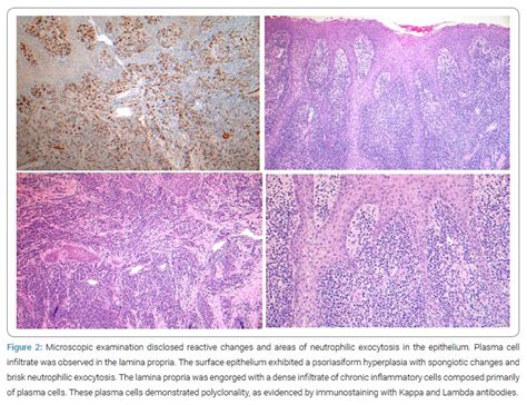 Gingival Hyperplasia Histology Nifedipine Induced Gingival Overgrowth