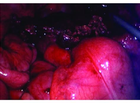 Intraoperative Laparoscopic View Shows Enlarged Inflamed And Download Scientific Diagram