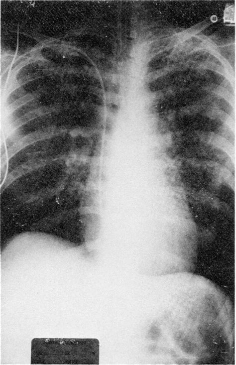 Radiograph With Bilateral Diffuse Infiltrates Download Scientific