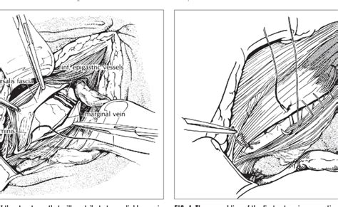 Shouldice No Mesh Inguinal Hernia Surgery Otosection