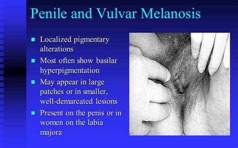Differences Between Penile And Vulva Melanosis And Melanoma Sexpally