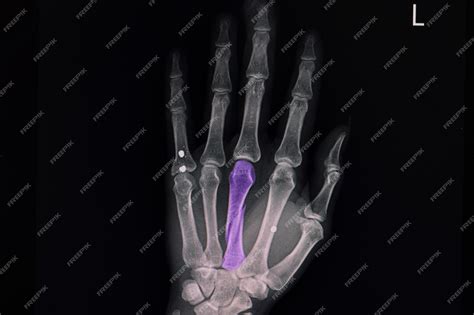 Broken Metacarpal X Ray
