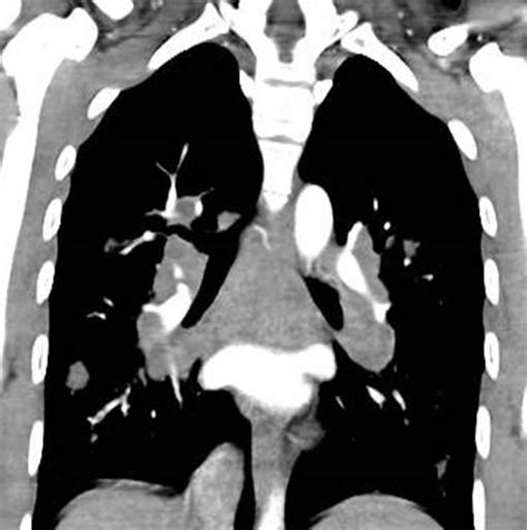 Mediastinal Lymph Node Enlargement Pacs