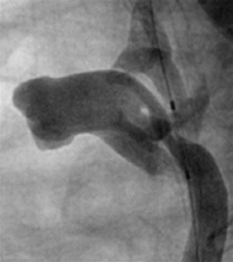 Retrograde Aortogram In Patient 11 A 1500 G Premature Infant Under Iv