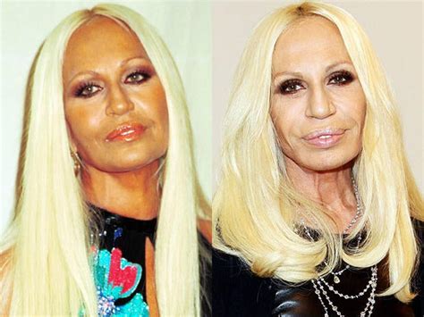 Celebrity Plastic Surgery Disasters Photo 1 Cbs News